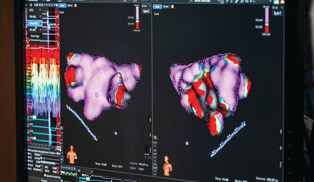 Atrial Fibrillation